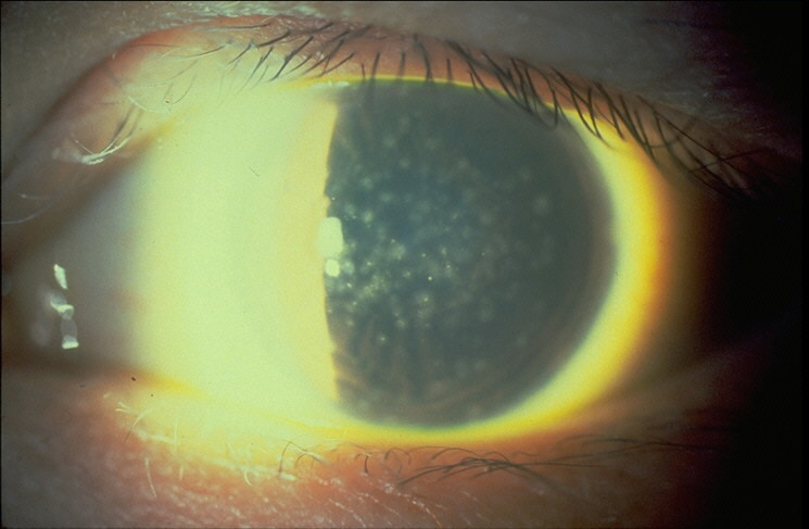 Epithelium : Bausch + Lomb